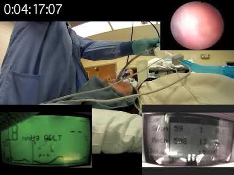 Fiberoptic Intubation Air-Q SGA with Continuous Ventilation by Jim ...