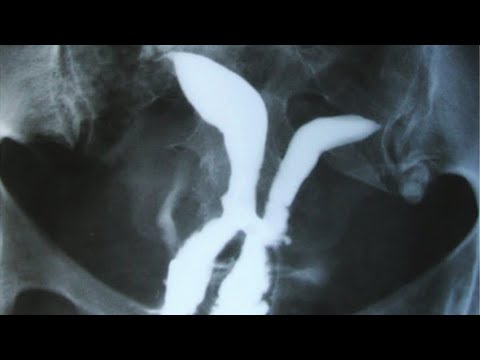 Reconstruction of complete vaginal cervical uterine septum by Shawki ...