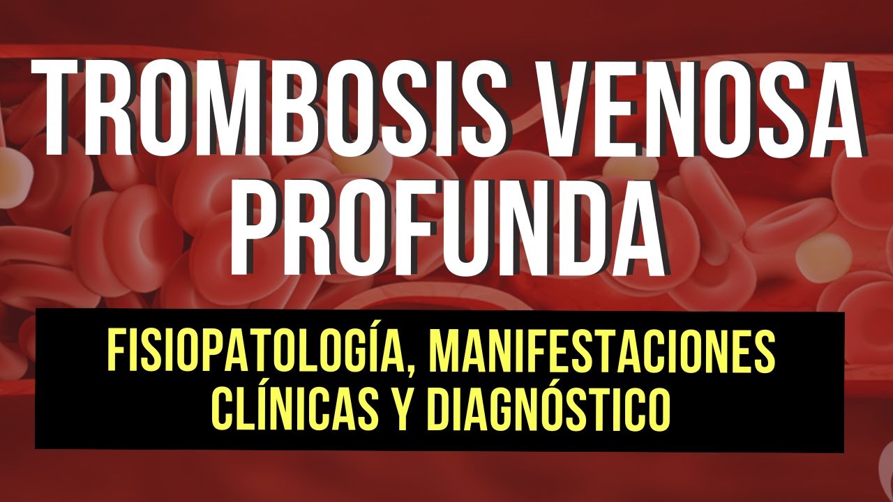Trombosis Venosa Profunda | Fisiopatología, Manifestaciones Clínicas y ...