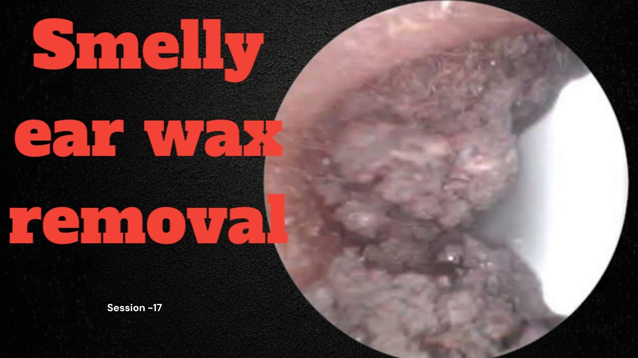 Smelly ear wax removal || ear cleaning || by D.r HARI (MBBS) - YouTube