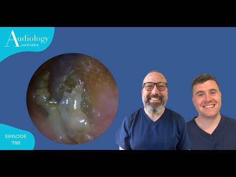 CRUSTY HARD EAR INFECTION REMOVAL - EP788 - YouTube
