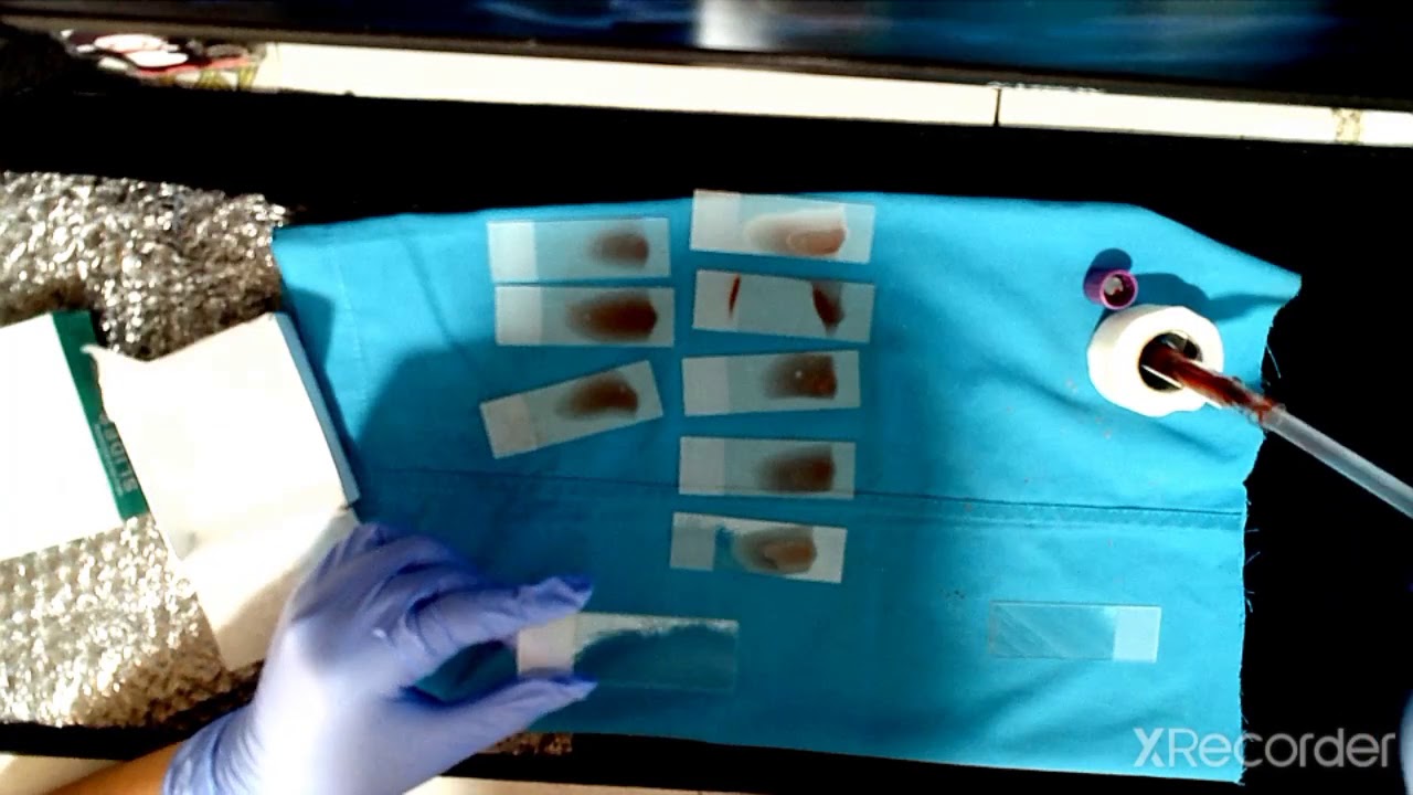[HEMATOLOGY] Blood Smear Video II - YouTube