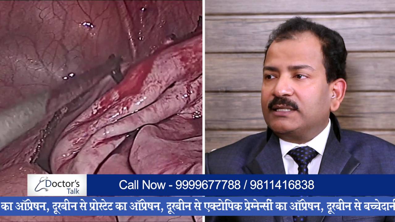 Rasoli ka durbeen ke operation se ilaaj - YouTube