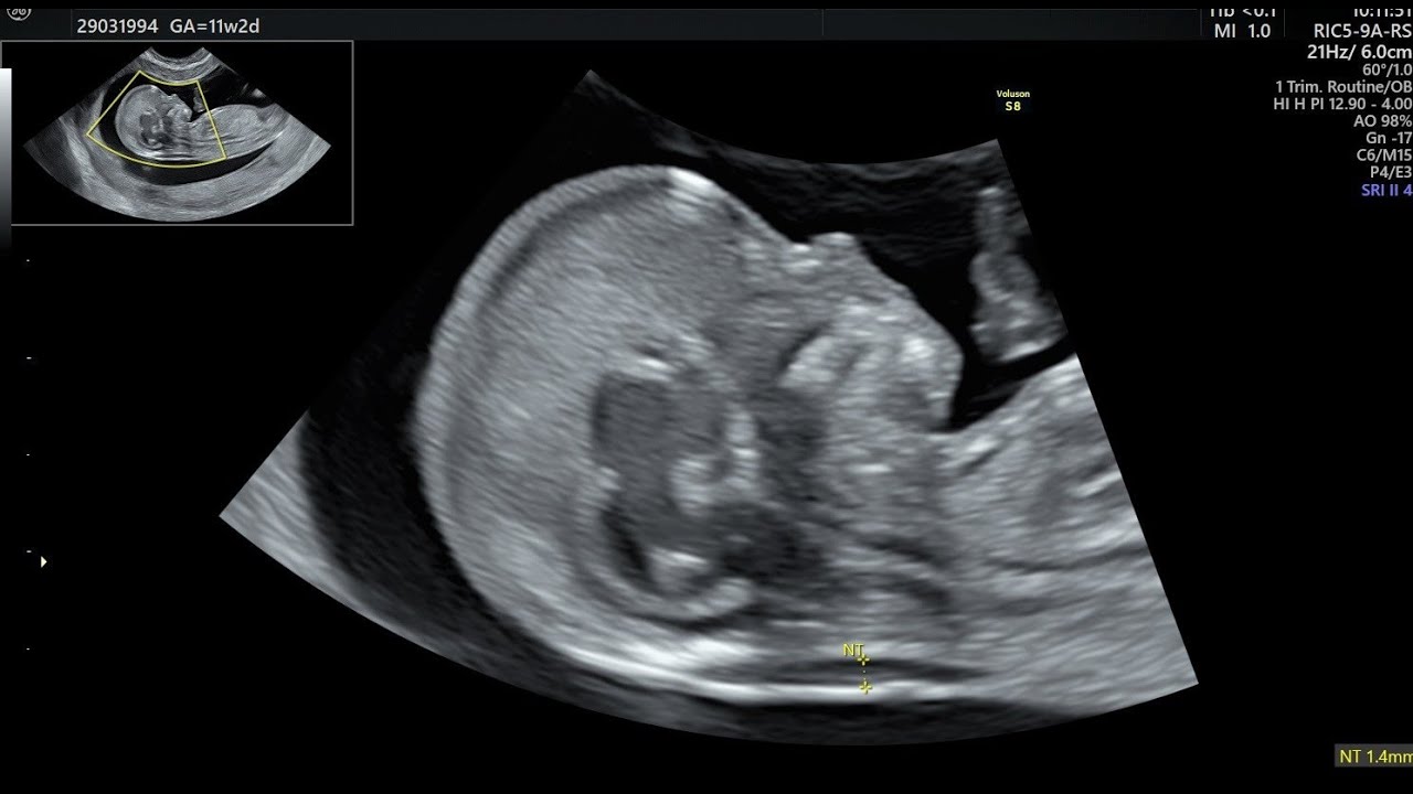 Dr Mirjana Anđelić – Ekspertni ultrazvuk i vođenje trudnoće – Beba u 12 ...