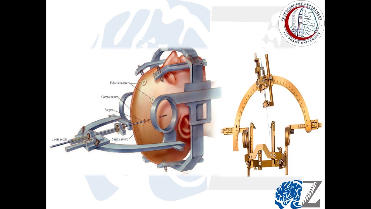 Principles of Brain Stereotaxy استخدام الستيريوتاكسي في جراحات المخ ...
