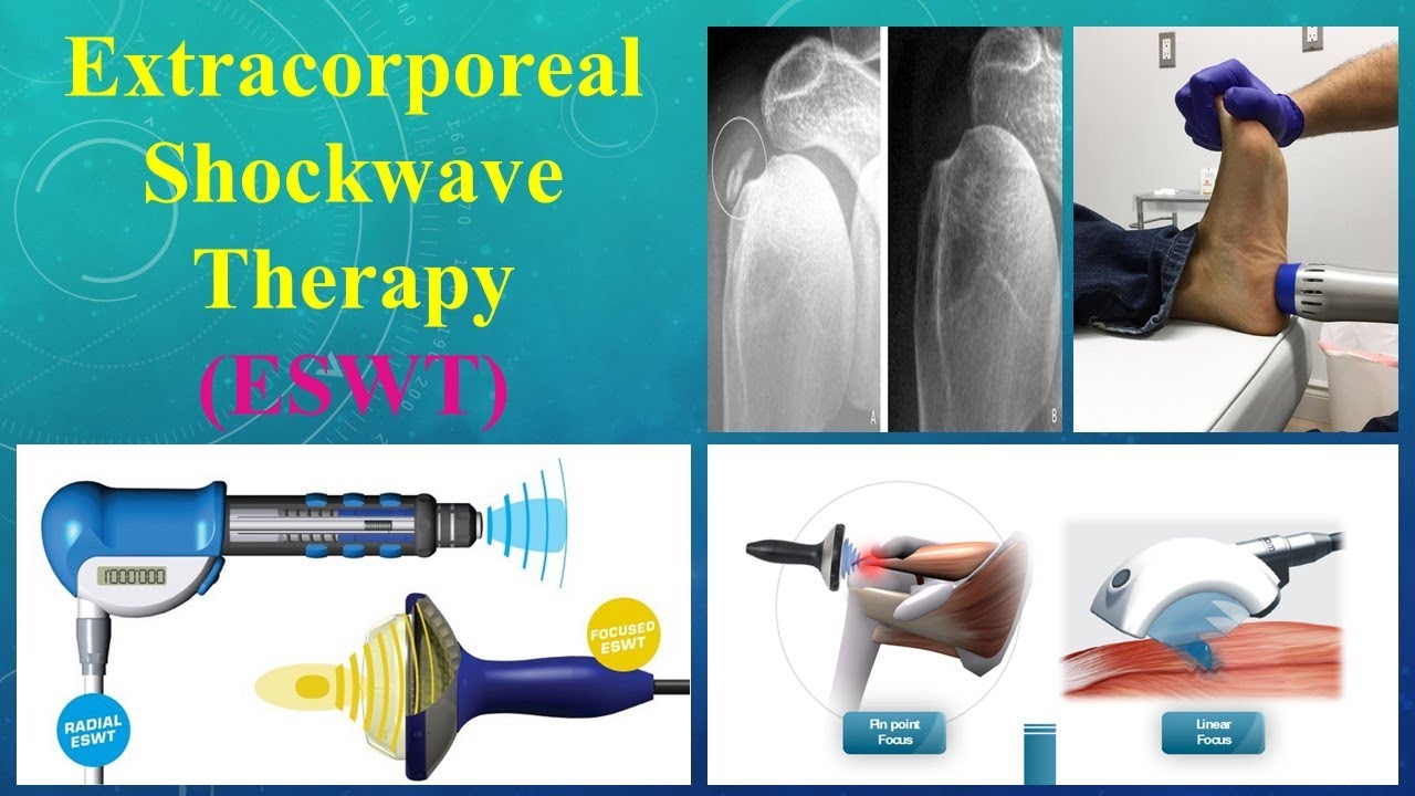 Extracorporeal Shockwave Therapy (ESWT)Section-Electrotherapy-2nd Year ...