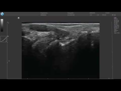 Cisti gangliare dorsale del polso - YouTube