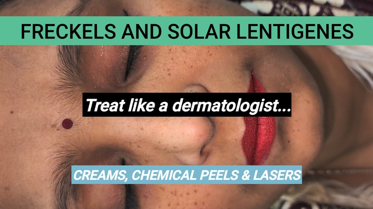 How dermatologist treat freckles??? @DrArifMDDermatologist #freckles # ...