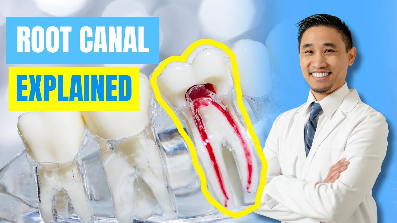 What Is a Root Canal? Why You Might Need One & How It Works - YouTube