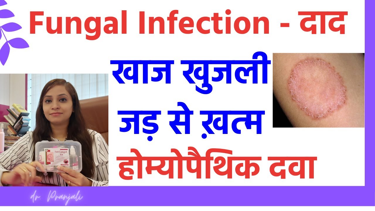 Fungal Infection Treatment By Homeopathy Ringworm Treatment Khujli And Daad Ki Dawa Youtube
