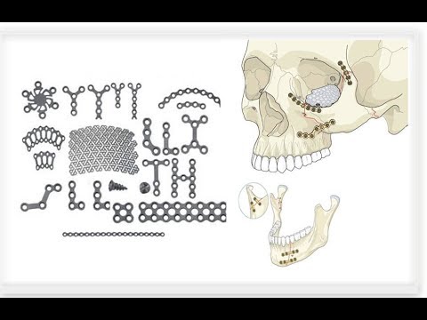 Maxillofacial screws & plates - YouTube