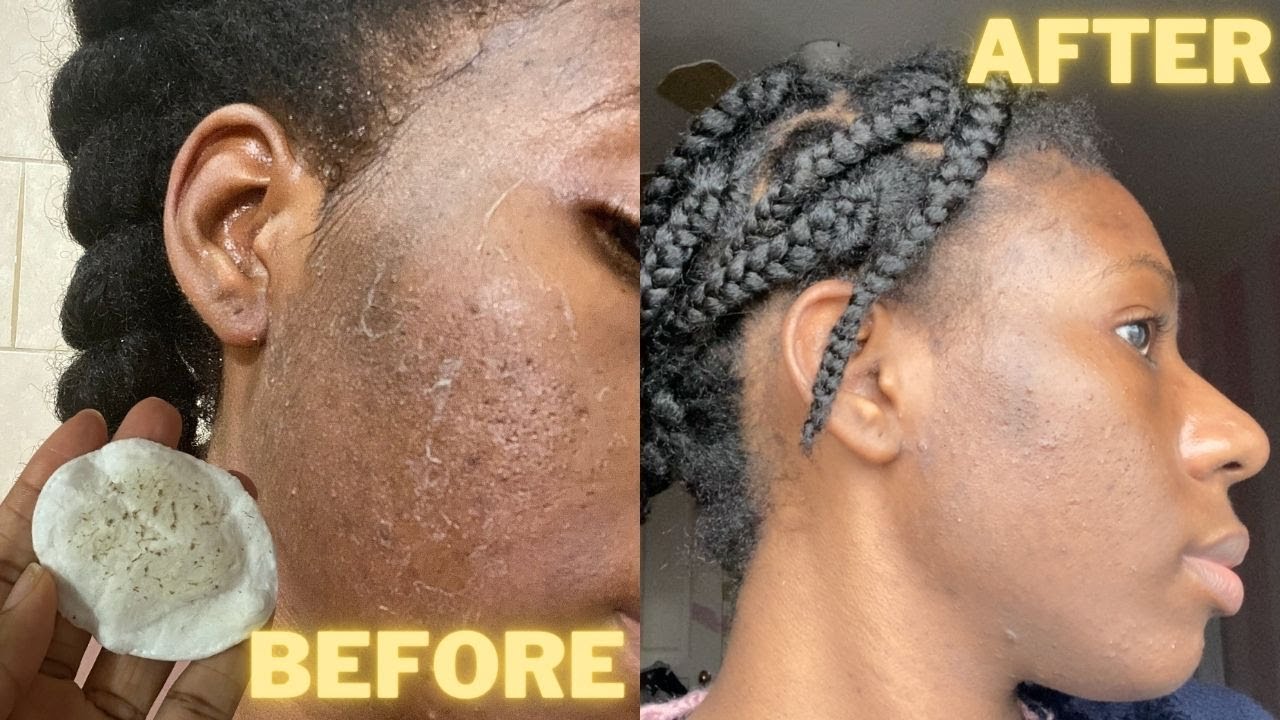 PCA SKIN CHEMICAL PEEL FULL EXPERIENCE | BEFORE & AFTER | * raw * - YouTube
