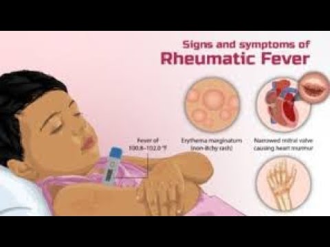 Acute Rheumatic Fever ; Causes, Symptoms, Signs, Diagnosis and ...