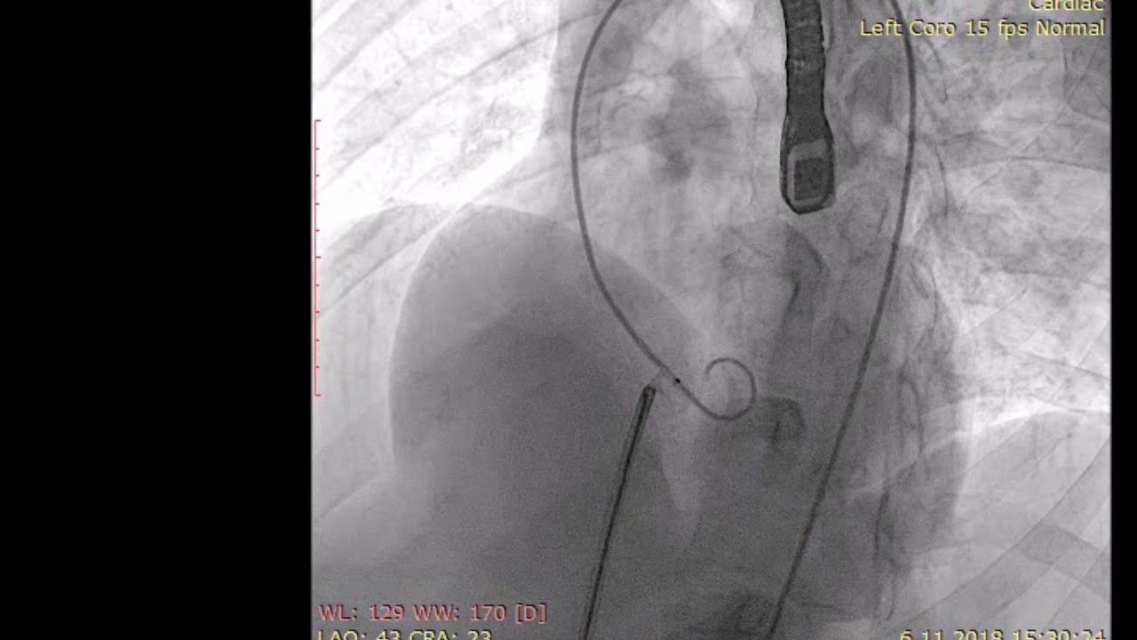 TRANSCATHETER CLOSURE OF MUSCULAR VSD AND MULTIPLE ASD IN AN ADULT ...