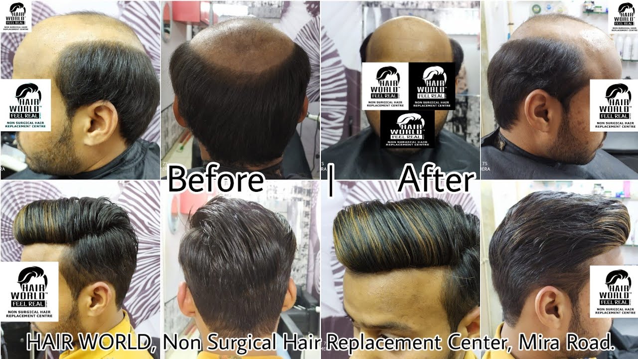 Hair Fixing For Men | Hair Wigs For Men | Hair Patch | Hair System ...