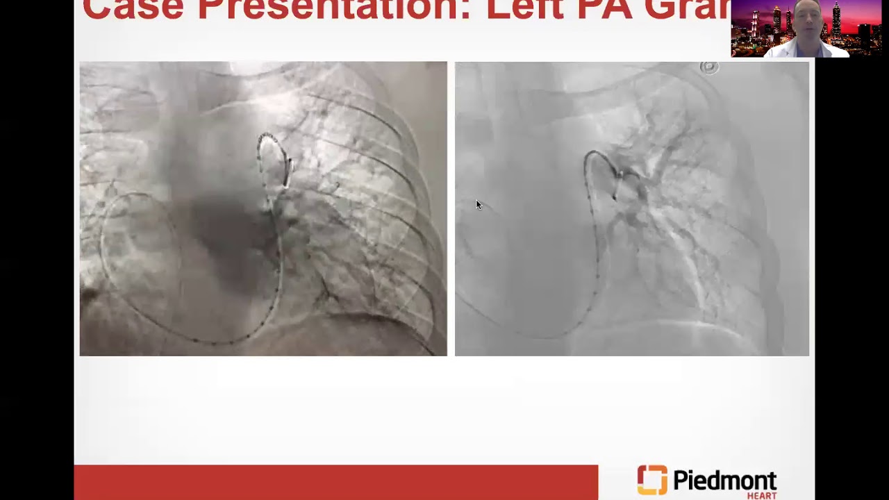 Catheter Intervention in Acute PE: It Saved my Patient_Klein_Peripheral ...
