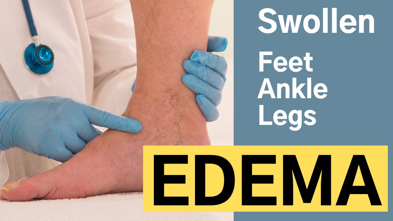 Edema | Top 10 Causes of Edema | Swelling the Causes, Symptoms, and ...
