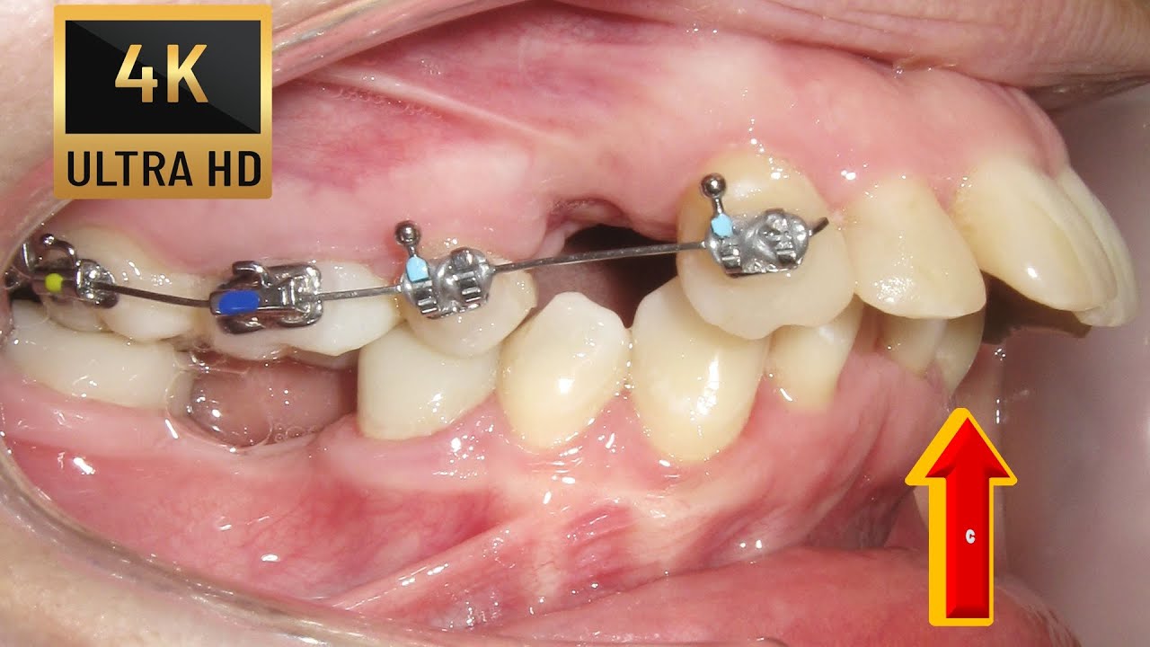 OVERJET in Adults Braces in 4 k resolution! - YouTube