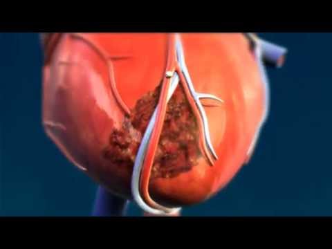 Heart Tissue Scarring - YouTube