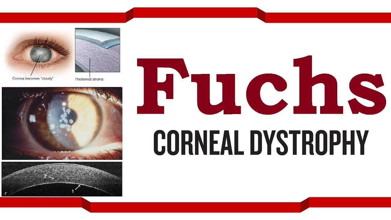 Fuch's Corneal Dystrophy (English) - YouTube
