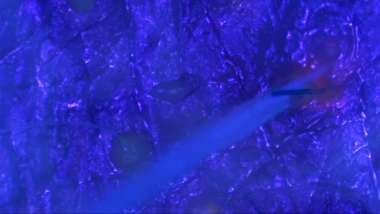 My Face Skin Demodex Video 3 - UV Light - YouTube