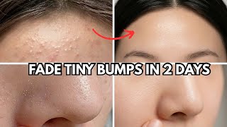 How to Get Rid of Tiny Bumps on Your Face at home(Naturally & Fast)