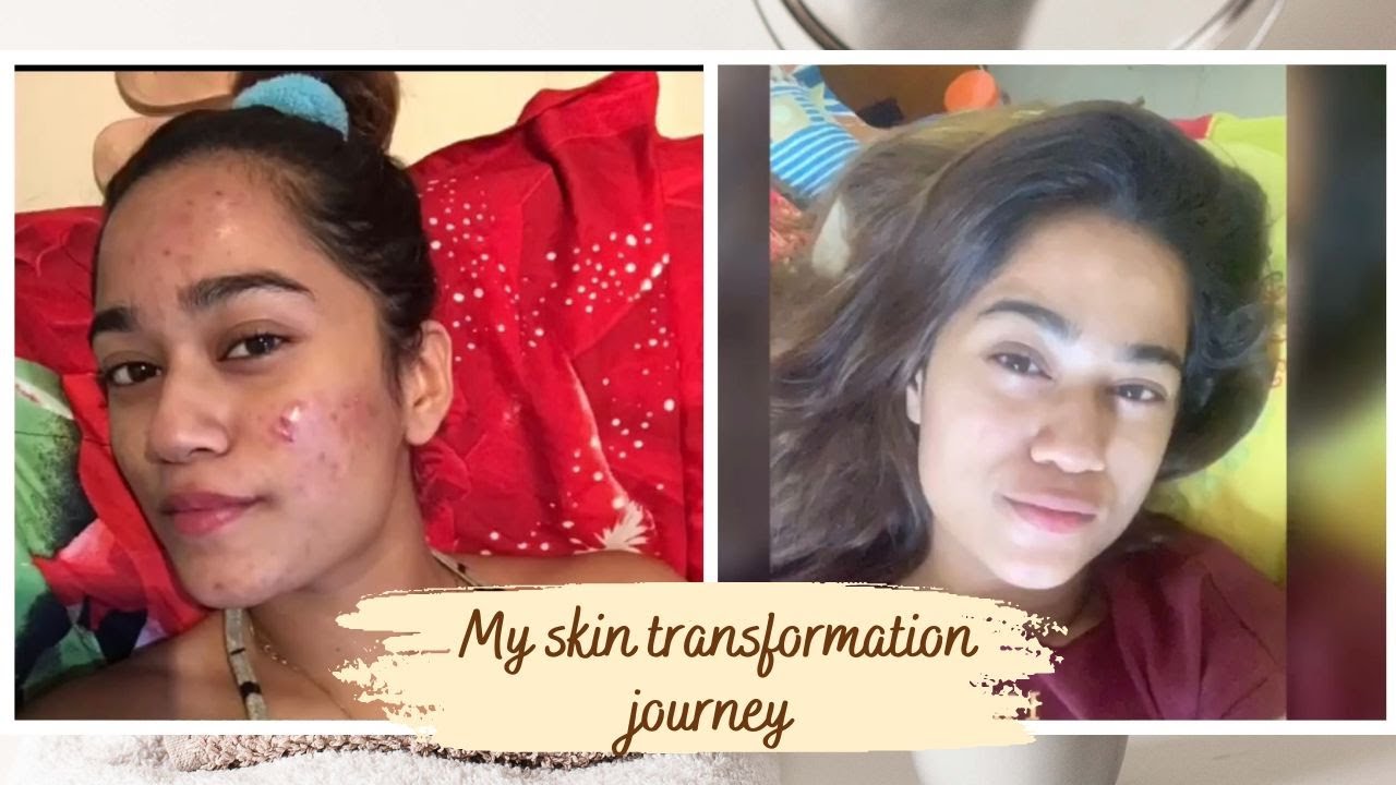 My skin transformation journey | Acne & Acne Scars | Shriya Jain - YouTube