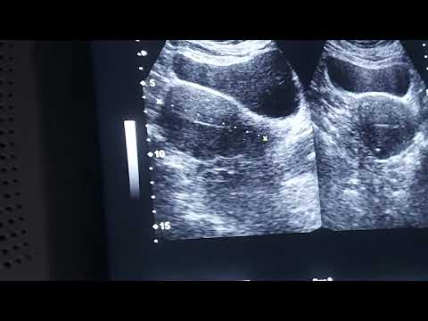 ultrasound uterus ..normal uterus measurements - YouTube