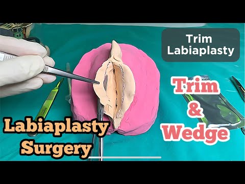 Labia Minora Nedir? Labioplasti Nasıl Yapılır? | Op. Dr. Funda Yazıcı Erol