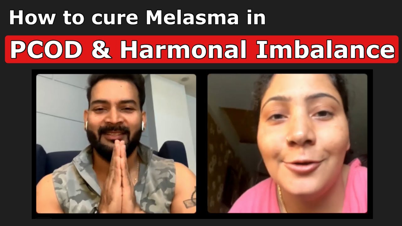 How to cure Melasma in “PCOD & Harmonal Imbalance”? - YouTube