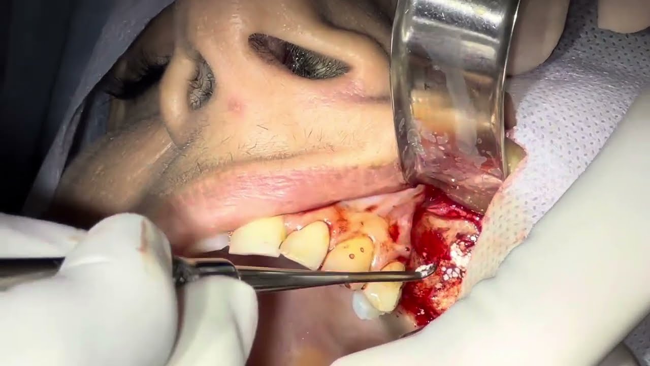 CIRURGIA DE LEVANTAMENTO DE SEIO MAXILAR - YouTube