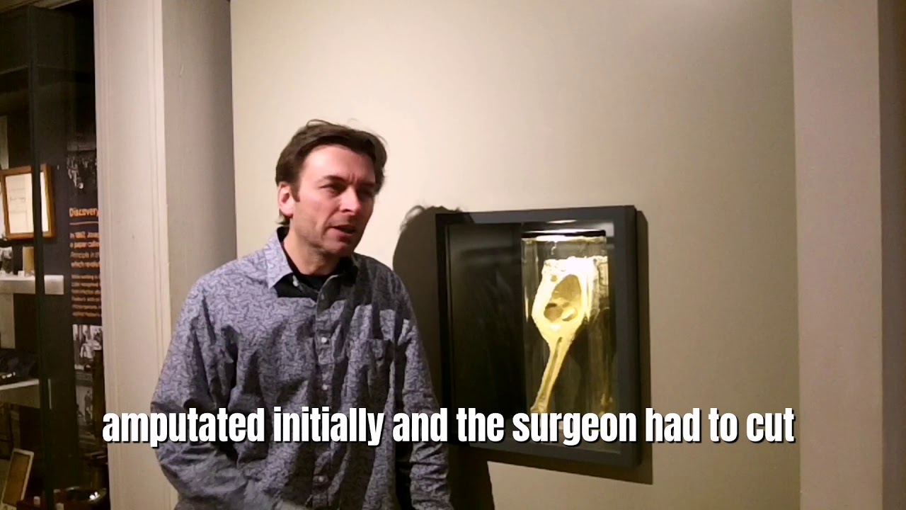 Tales from Surgeons' Hall: Amputated Leg of Charles Anderson - YouTube