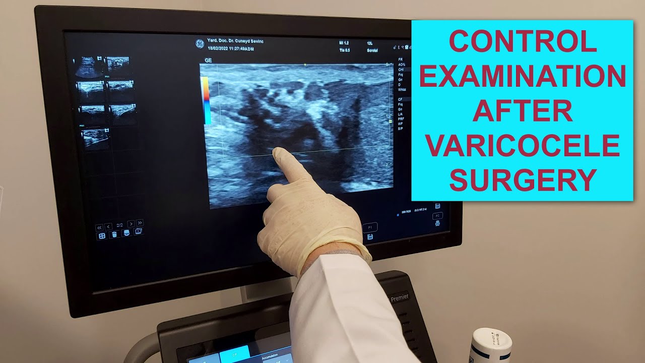 Control Examination on the 2nd month after Microsurgery Varicocele ...