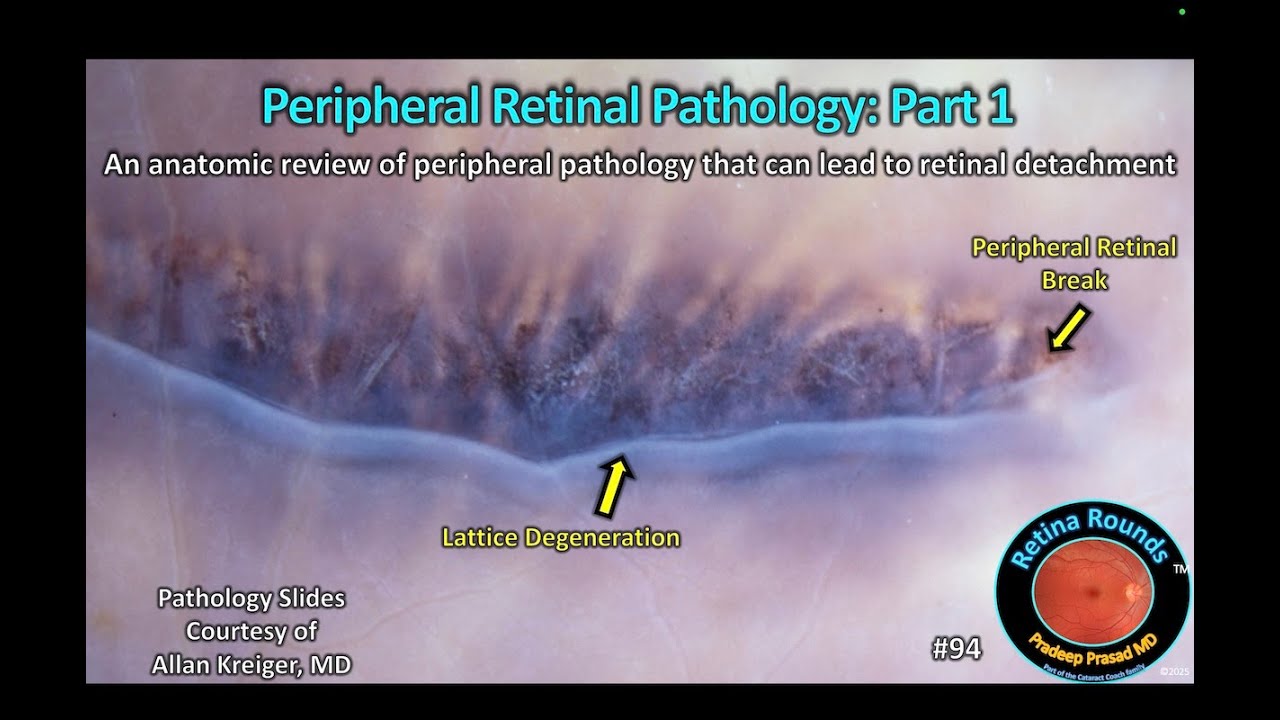 RetinaRounds™ 94: Peripheral Retinal Pathology: Part 1 - YouTube