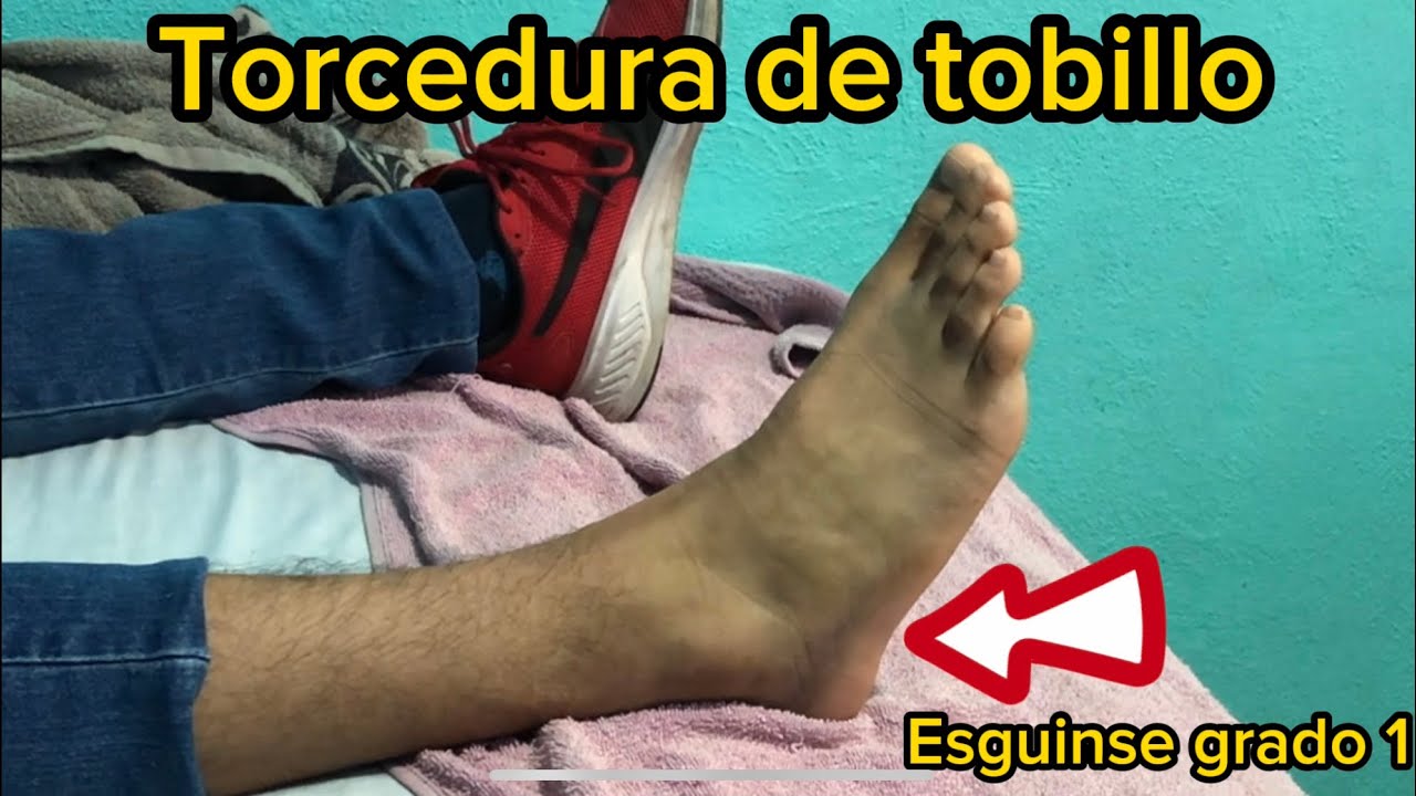 Torcedura de tobillo, cómo aliviar el dolor de tobillo, esguinse de ...