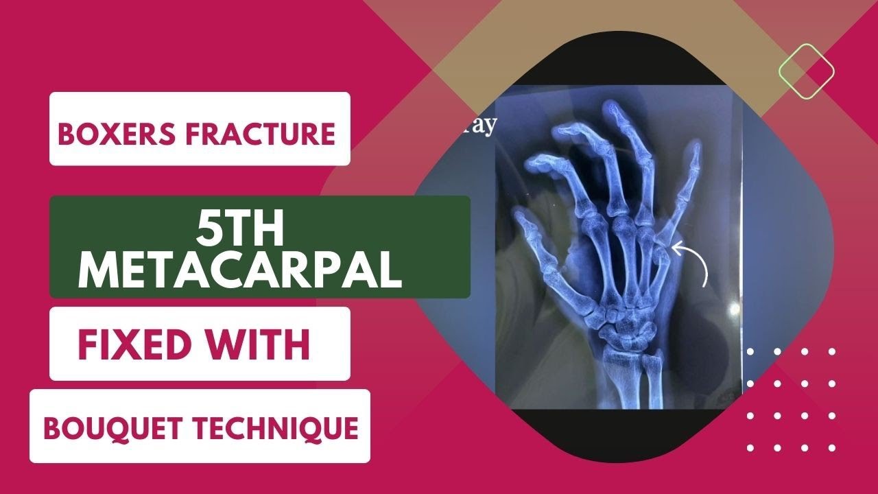 BOXERS FRACTURE(5TH METACARPAL) FIXED WITH BOUQUET TECHNIQUE WITH ...