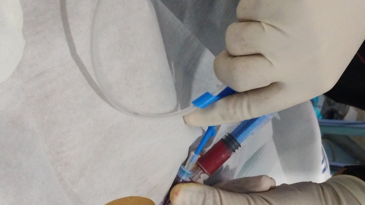 Central venous line l CV line কি!কেন করা হয়?কিভাবে করা হয়!Dr Amdadul ...