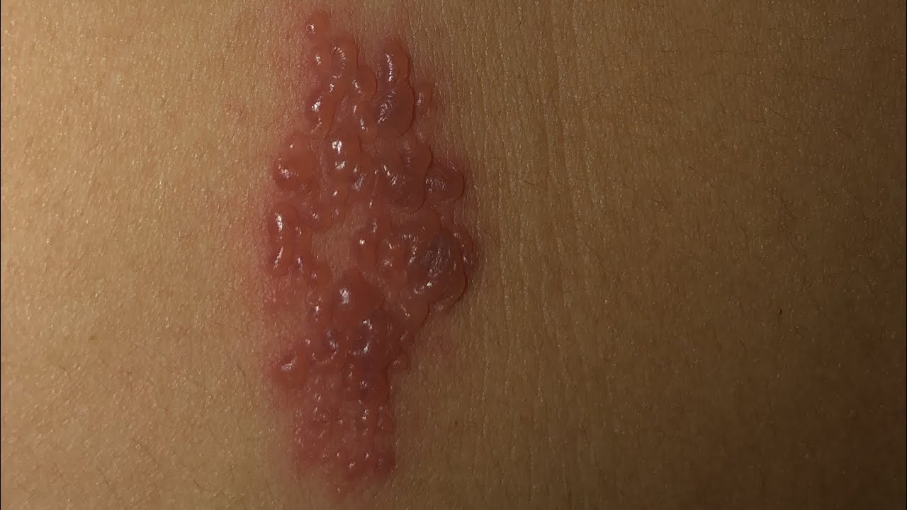 Herpes Zoster (Cobreiro) - YouTube