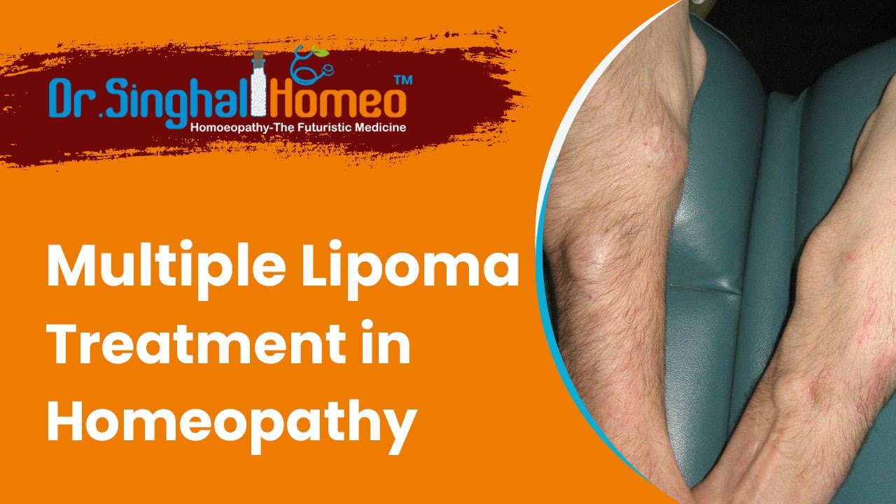 Multiple Lipoma Treatment in Homeopathy || होम्योपैथी में मल्टिपल ...