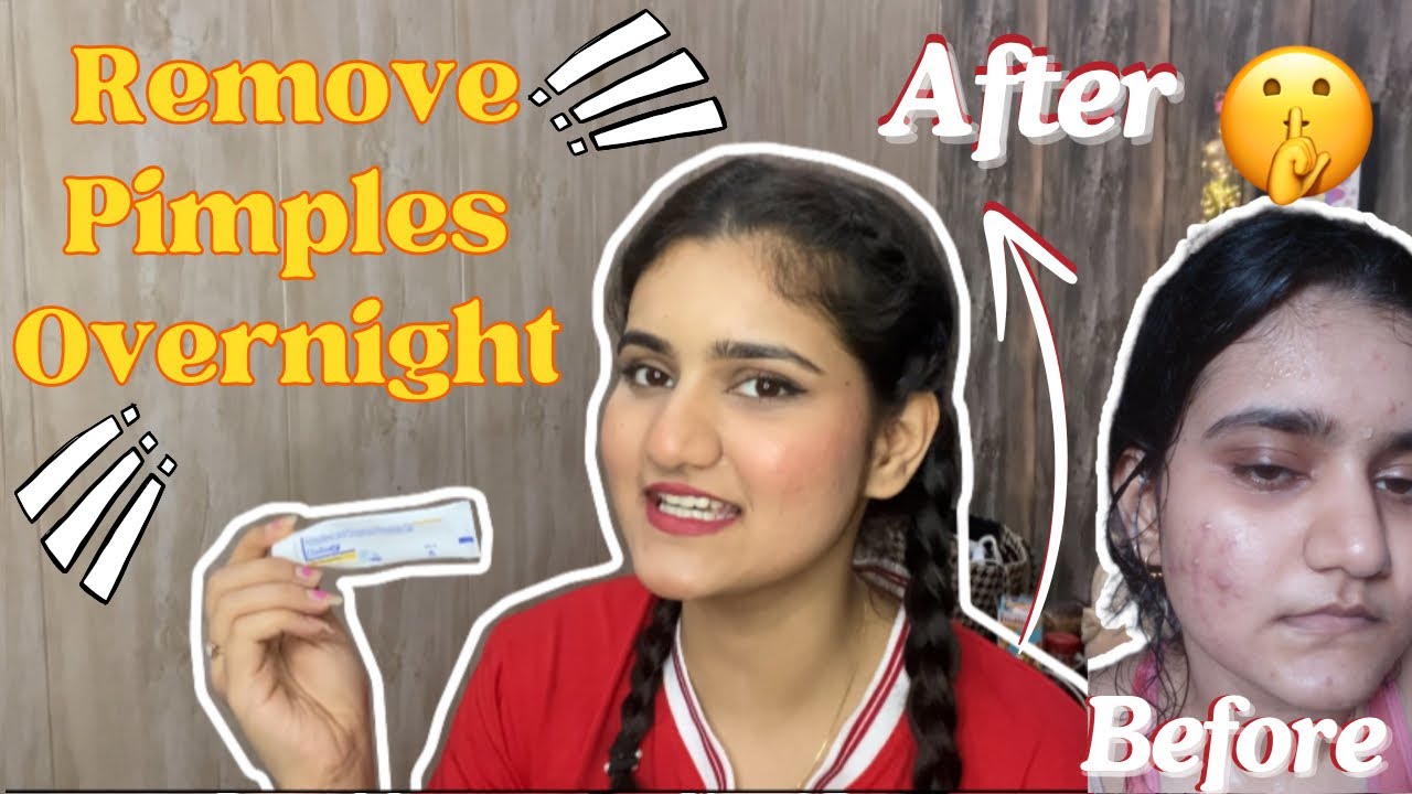 How to remove Pimples Overnight | *Secret* cream that helped me remove ...