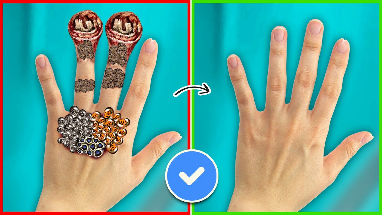 ASMR Remove Worm & Maggot Hand Infected | Severely Injured Treatment ...