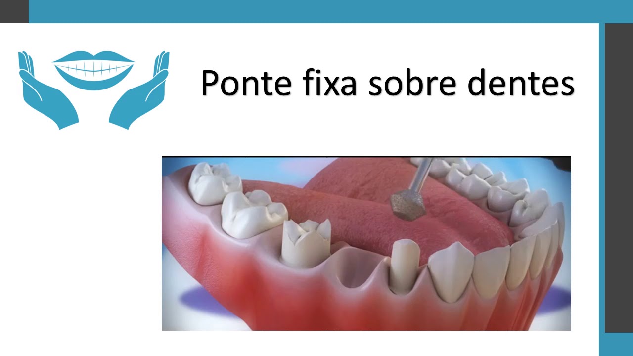 Ponte fixa sobre dentes - YouTube