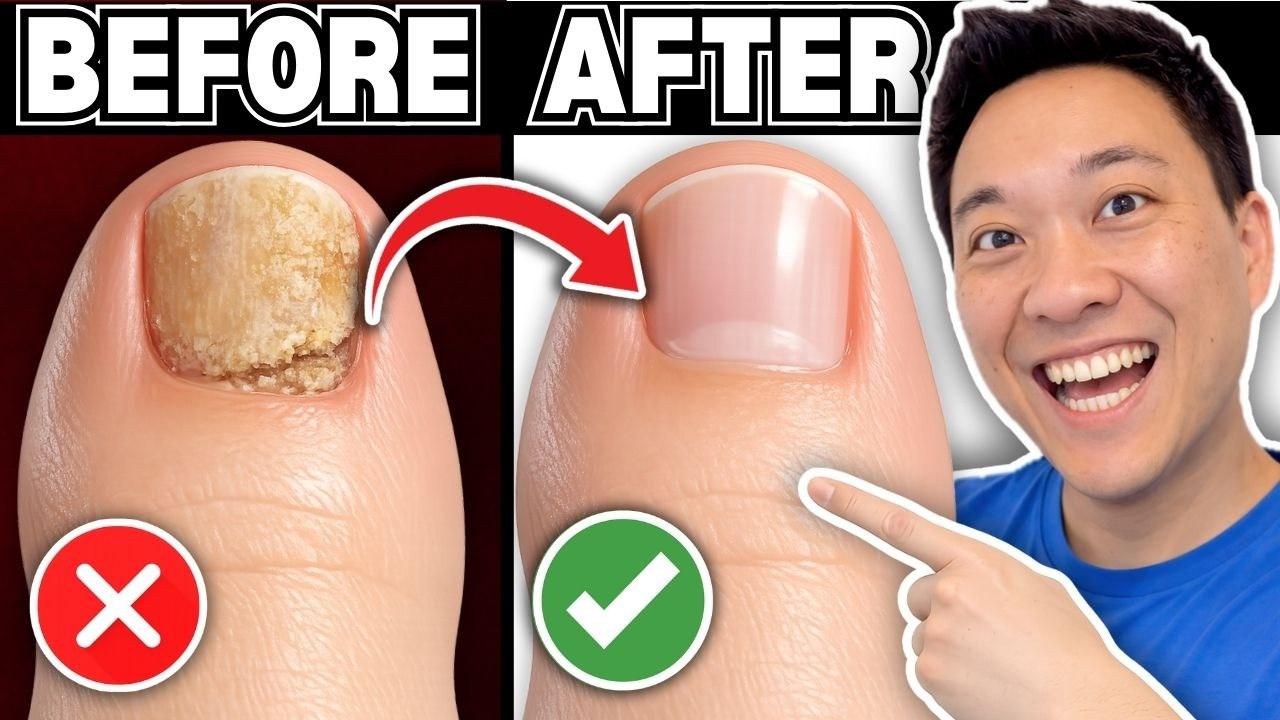 Toenail Fungus, Osteoarthritis & Root Cause Healing Explained - YouTube