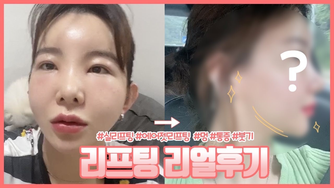 실리프팅 에어젯리프팅 입꼬리필러 리얼후기 직후 1일차 2일차 통증 멍 붓기 Youtube
