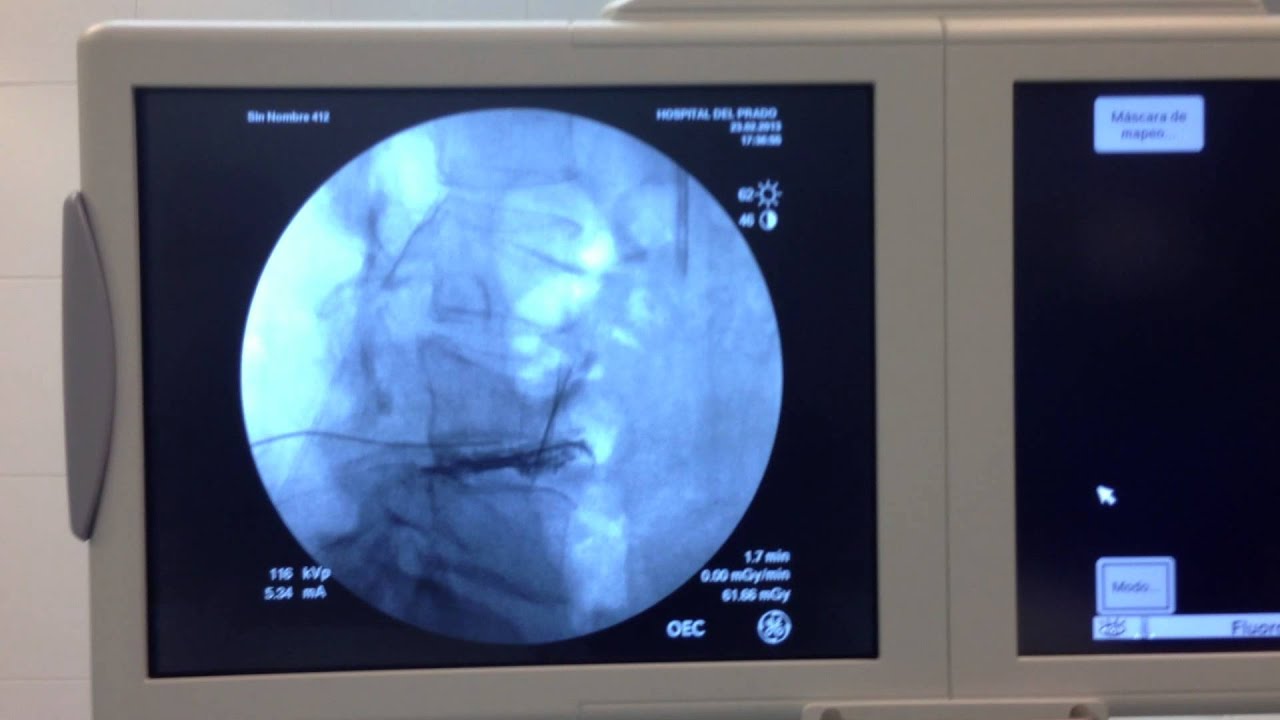 4 hernias de disco nucleoplastia, discolisis con ozono, Neurolisis ...