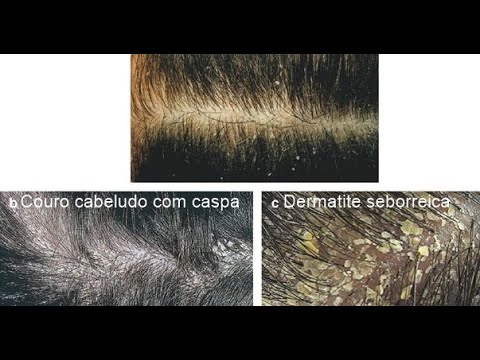 Descamação da pele do rosto Dermatite seborreia caspa na sobrancelha ...