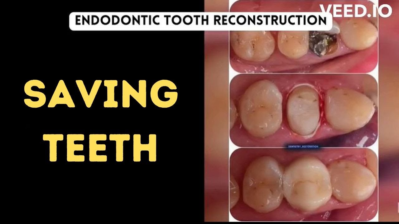 SAVING TEETH: Endodontic Tooth Reconstruction - YouTube