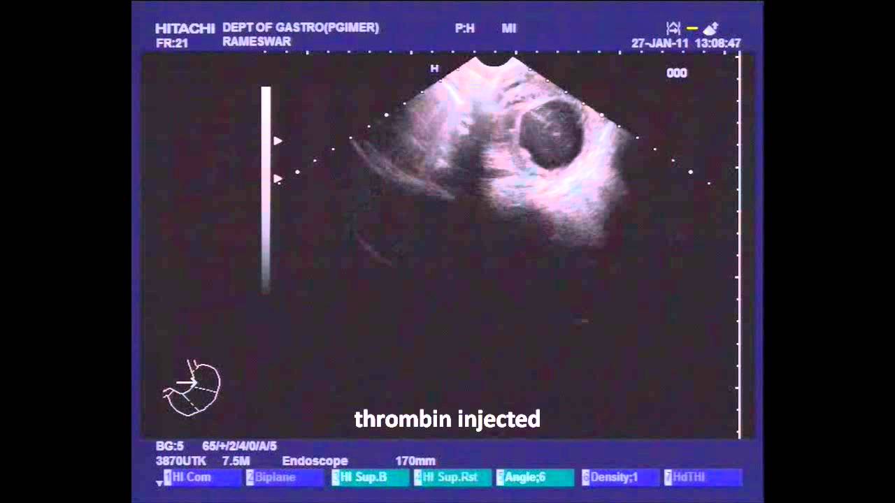 EUS- GUIDED THROMBIN INJECTION IN PANCREATIC PSEUDOANEURYSM - YouTube