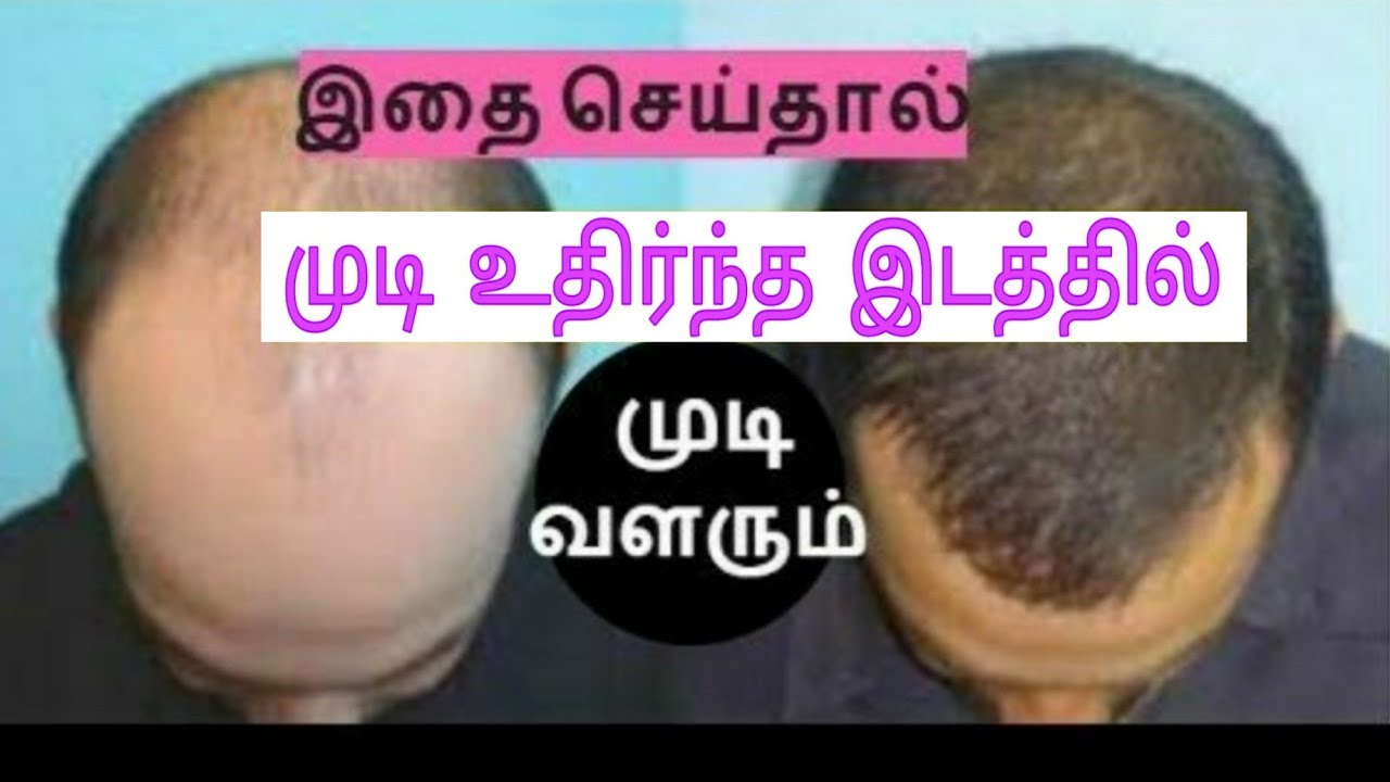 வழுக்கை தலையில் முடி வளர | நரை முடி போக| Valukkai, sotta thalaiyil mudi ...