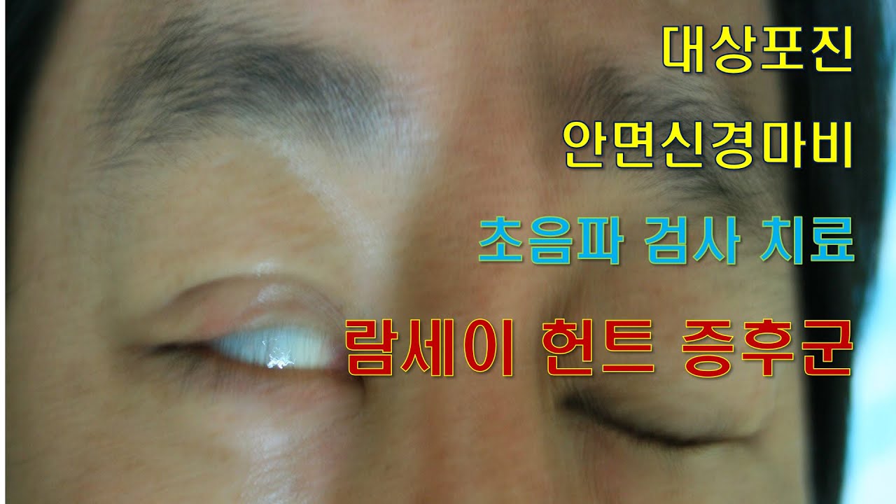 람세이헌트 증후군 신경치료로 고칠수 있습니다 Youtube